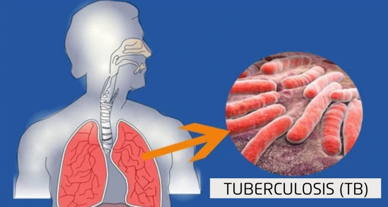 Tuberculosis Demystified: Causes, Symptoms, Prevention, and Treatment ...
