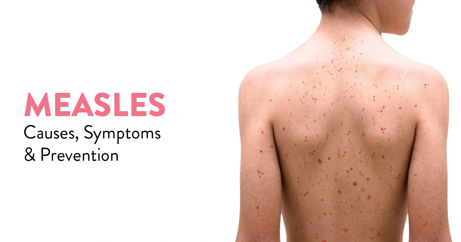 Understanding Measles: Causes, Symptoms, Prevention, and Modern Treatments - My Hospital Now