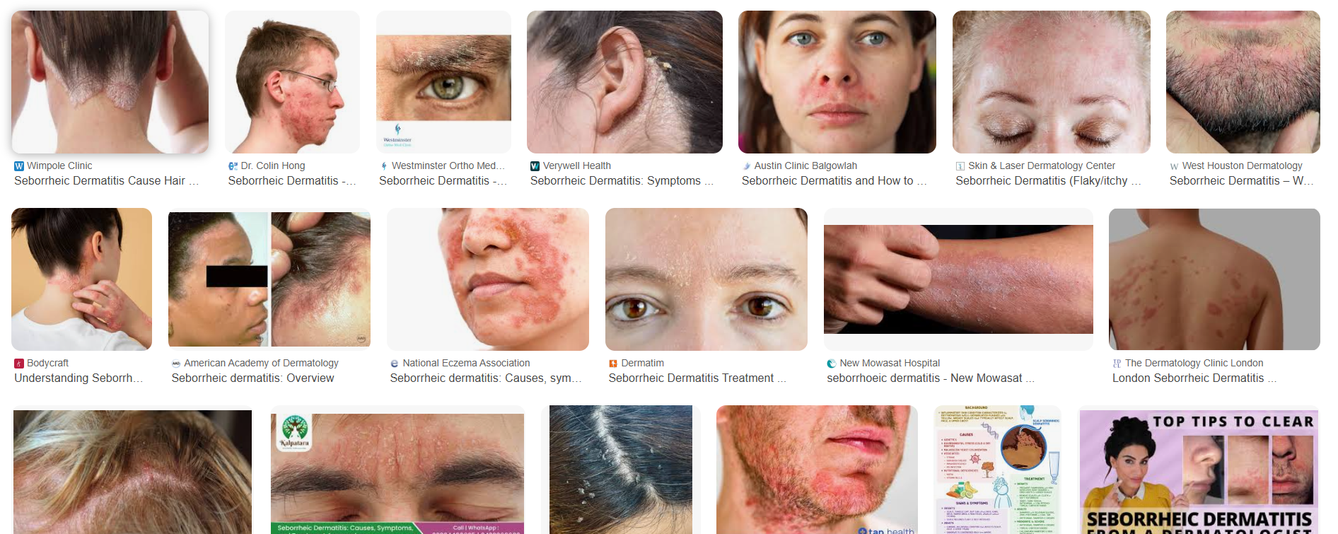 Seborrheic Dermatitis: A Comprehensive Guide – My Hospital Now