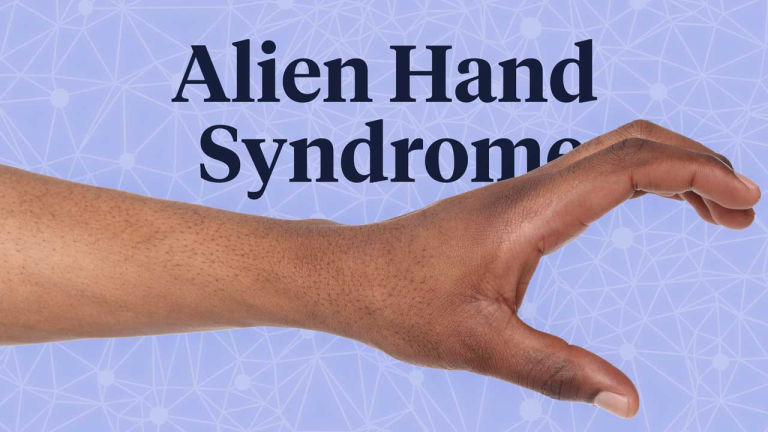 A Complete Guide to Alien Hand Syndrome: Causes, Symptoms, and ...