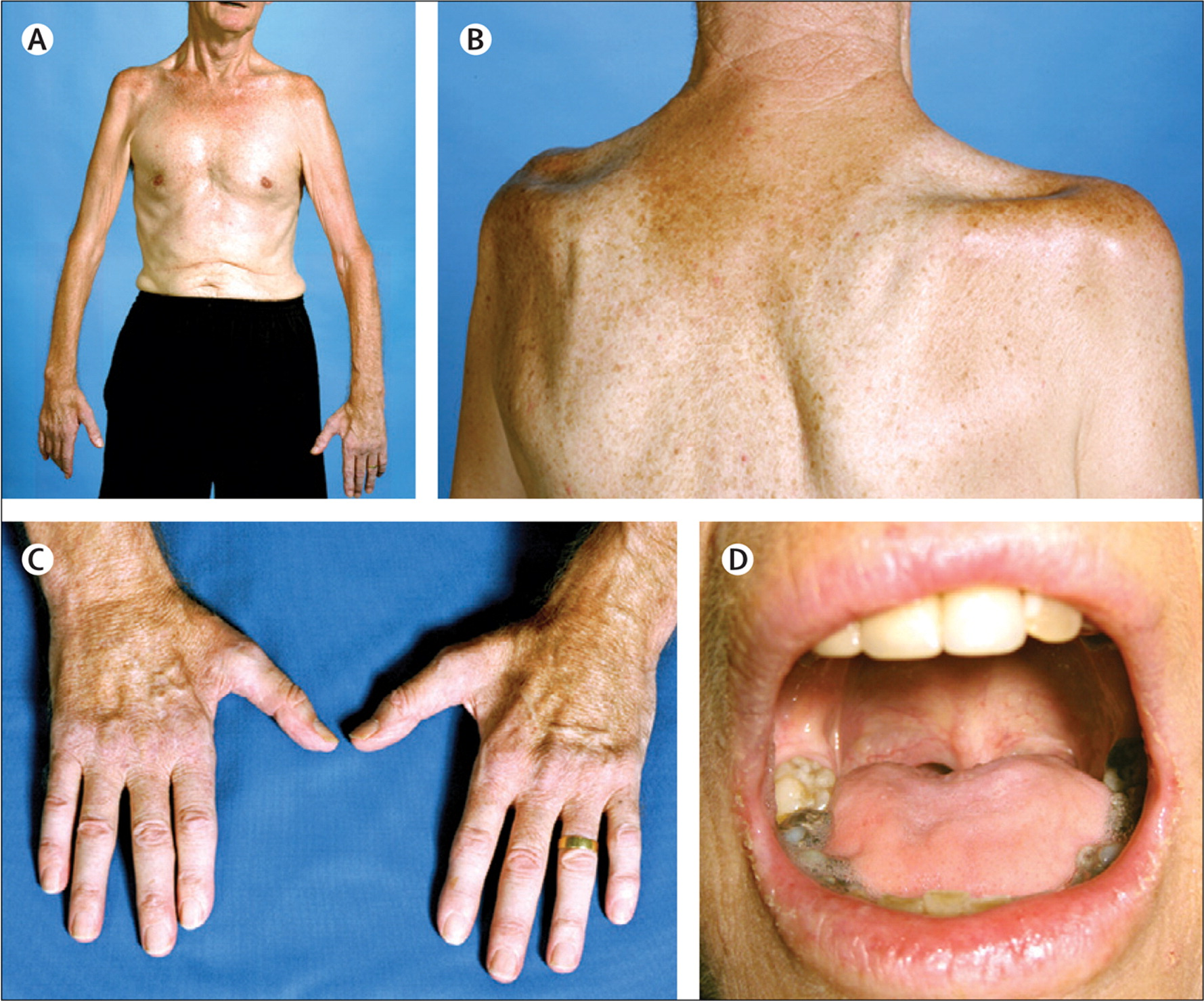 Amyotrophic Lateral Sclerosis (ALS): A Comprehensive Overview – My ...