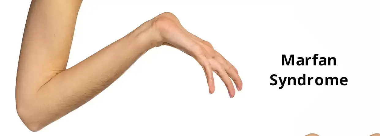 Understanding Marfan Syndrome: Causes, Symptoms, and Treatments - My ...