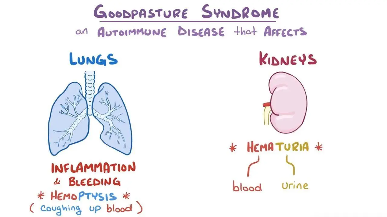 Unmasking Goodpasture Syndrome: A Guide to the Autoimmune Attack on ...