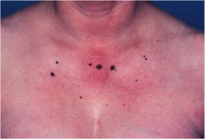 Blue Rubber Bleb Nevus Syndrome (BRBNS): A Complete Guide – My Hospital Now