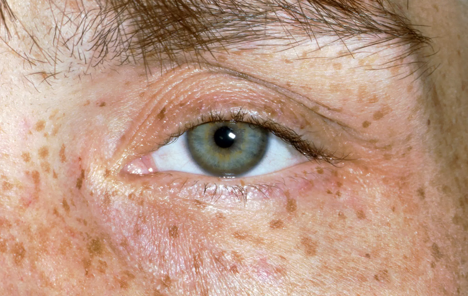 Understanding Wilson's Disease: Causes, Symptoms, and Treatment - My ...