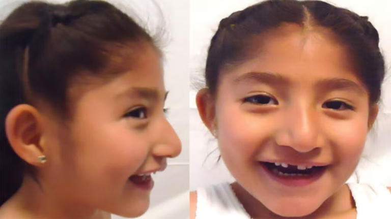 Living with Angelman Syndrome: Understanding the Causes, Symptoms, and ...